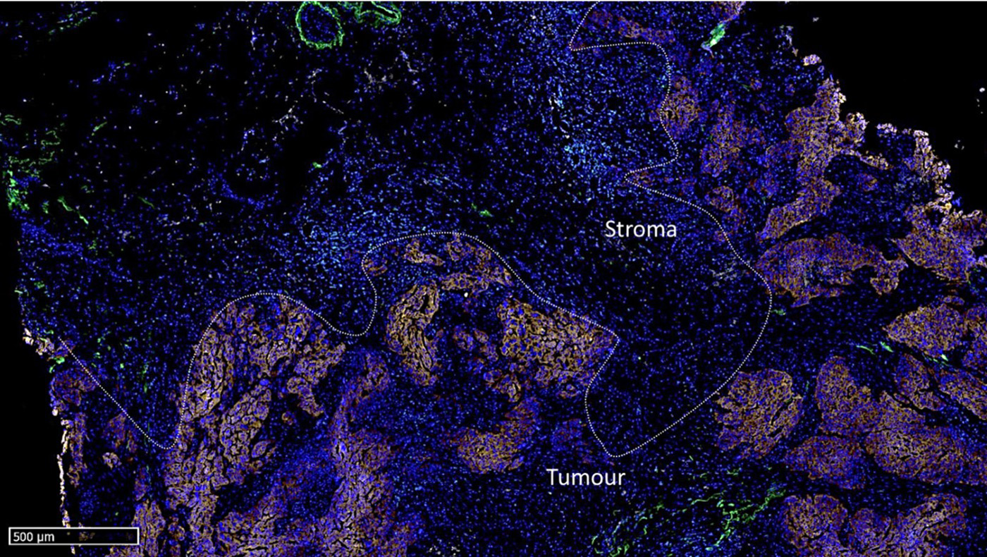 Eagle view multiplex scanning: unveiling cellular interactions in tumor ...