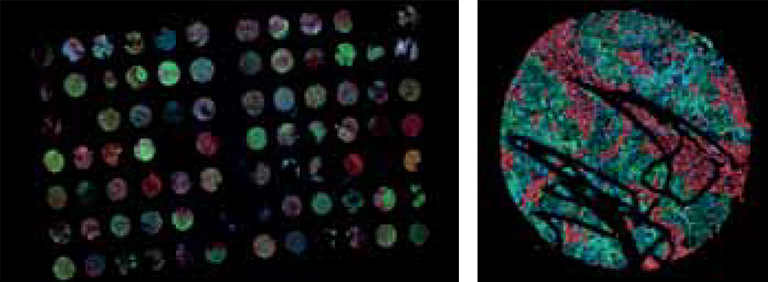 Tumour detection in Fluorescent Tissue Microarrays | Hamamatsu Photonics